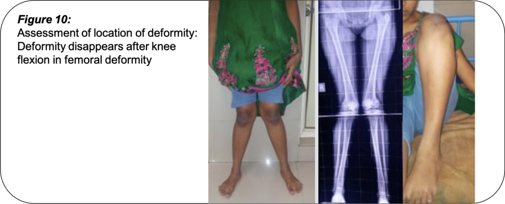 Bowlegs and Knock-knees - PinnacleOrthoCentre