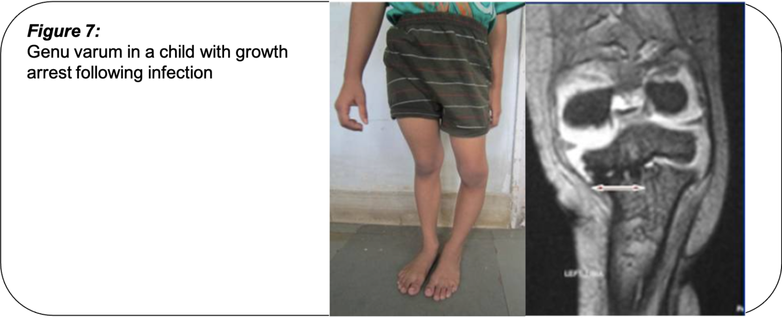 Bowlegs and Knock-knees - PinnacleOrthoCentre