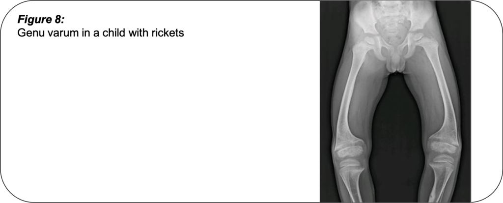 Bowlegs and Knock-knees - PinnacleOrthoCentre