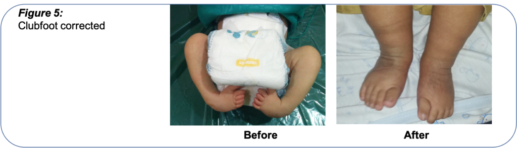 Best Clubfoot Treatment Hospital in Thane, Mumbai - Pinnacle