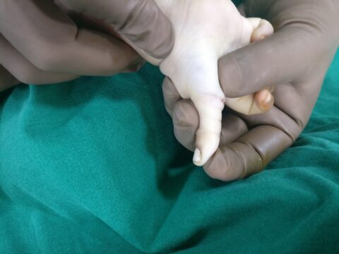 Trigger Finger and Trigger Thumb in Children - PinnacleOrthoCentre