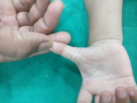 Trigger Finger and Trigger Thumb in Children - PinnacleOrthoCentre