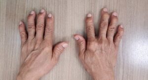 Hand Surgery for Rheumatoid Arthritis - PinnacleOrthoCentre