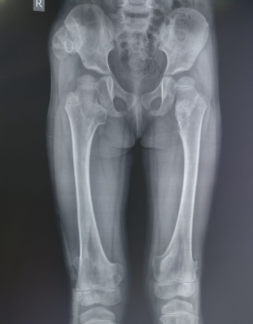 Hereditary Multiple Exostoses: Causes, Symptoms and Treatment