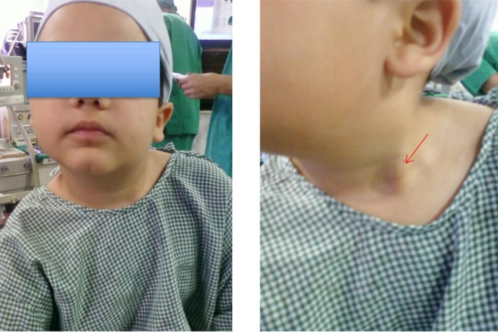 Congenital Muscular Torticollis - PinnacleOrthoCentre