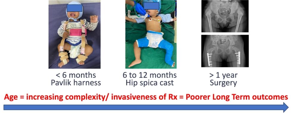 Hip Dysplasia in Babies: Symptoms, Causes and Treatment