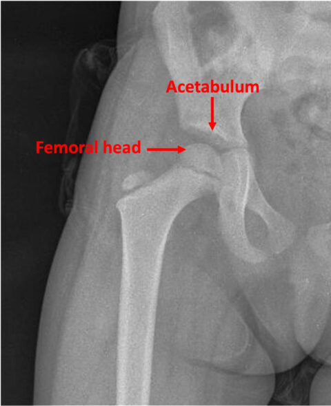 Neonate Screening for Developmental Dysplasia of Hip (DDH): Indian ...