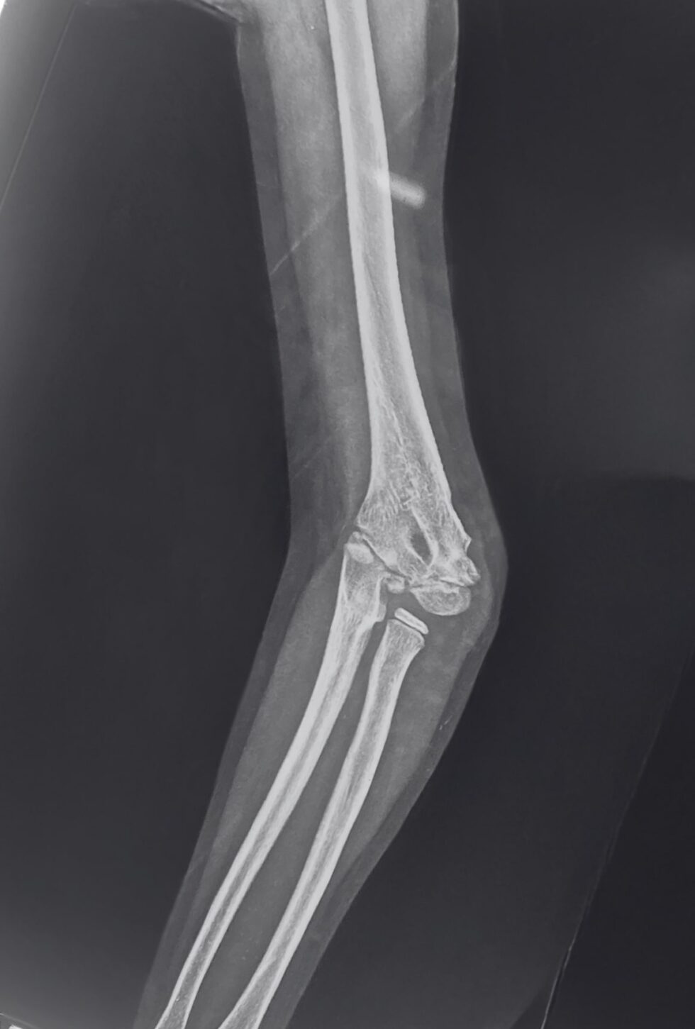 Elbow Cubitus varus deformity in 8 Years old child - PinnacleOrthoCentre