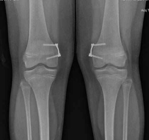 Knee Genu valgum deformity in 12 Years Old Male Child - PinnacleOrthoCentre