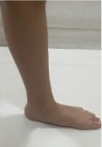 What is Flatfoot: Types of Flatfoot and How to Treat It?