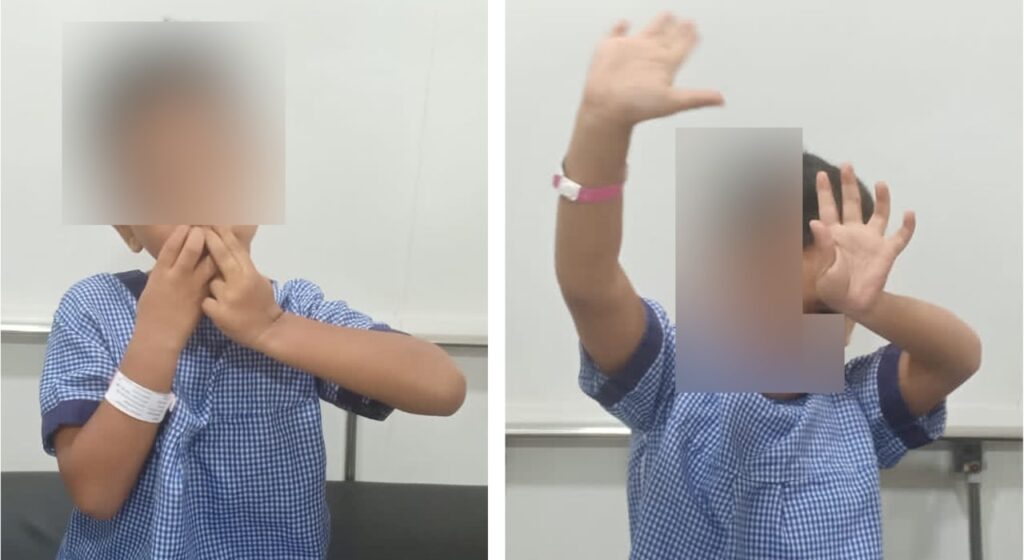 What is Brachial Plexus Birth Palsy: Problems of the shoulder joint